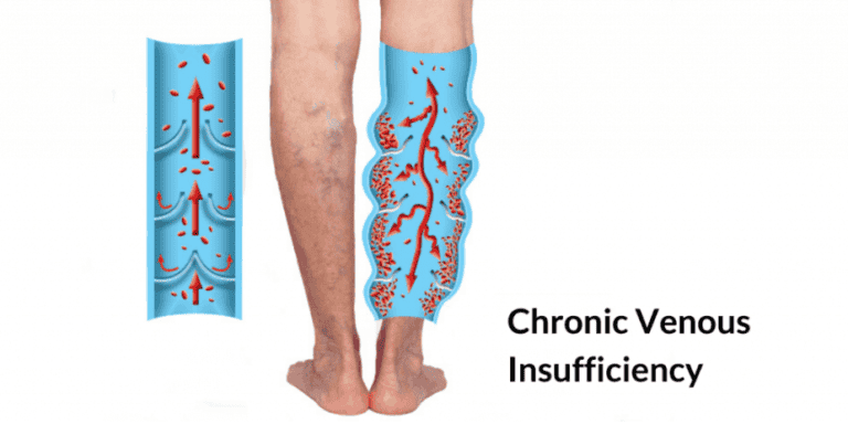 Understanding Causes of Open Wounds on Legs That Won’t Heal