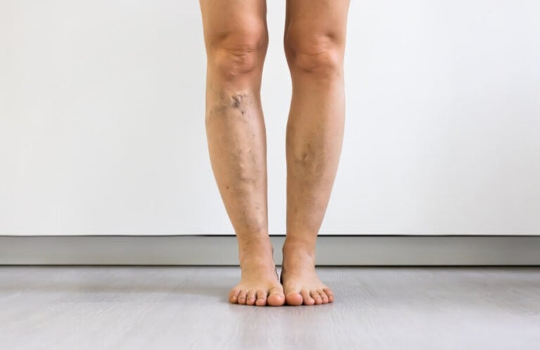 Discover The 9 Incredible Benefits Of Leg Elevation