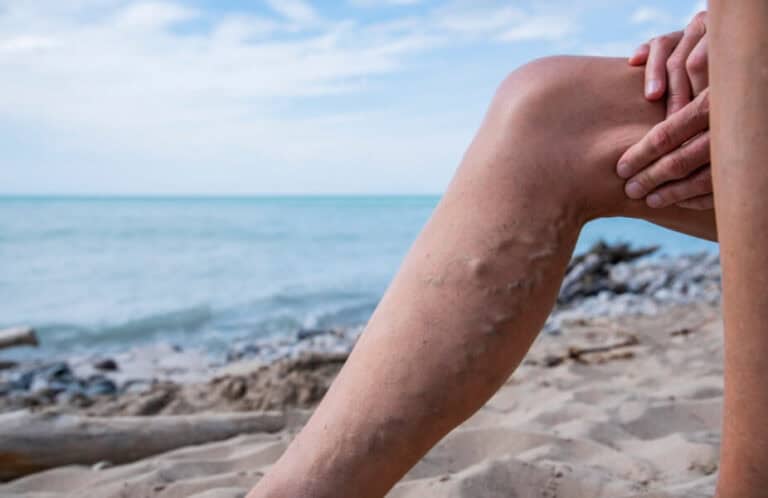 Bulging Veins in Legs: Identifying Causes & Treatment Options