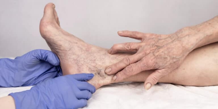 Spider Vein Telangiectasia on Legs: Causes & Treatment Options