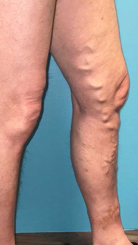 Vein Envy® - Top Rated Arizona Varicose & Spider Vein Clinic